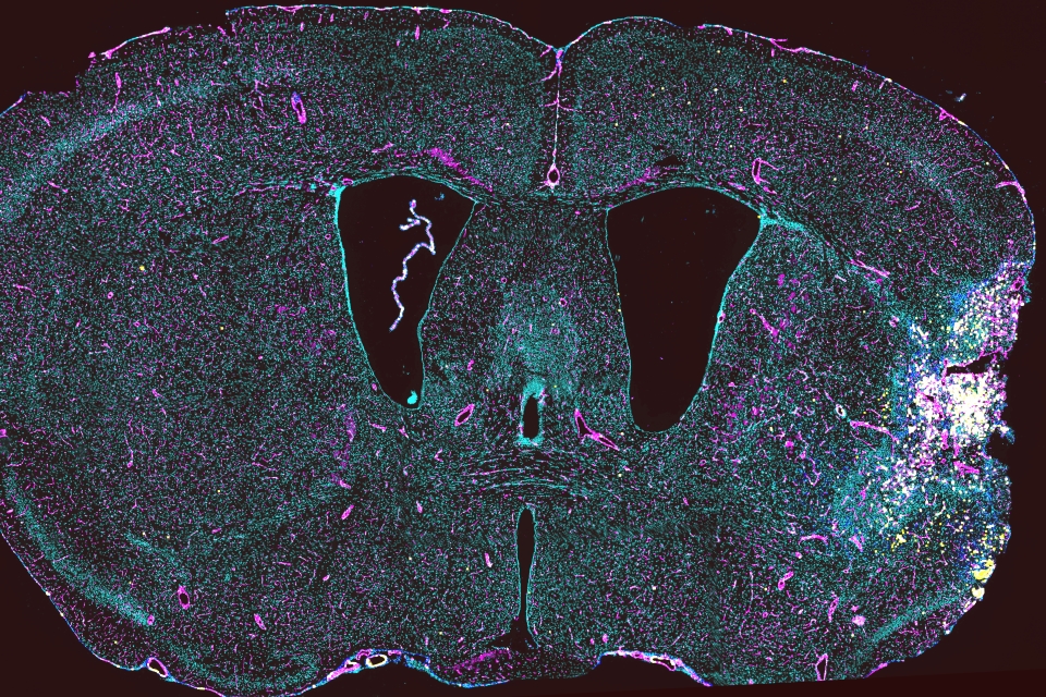 Mapping Brain Repair and Remodelling After Stroke | Newsroom | Weill ...
