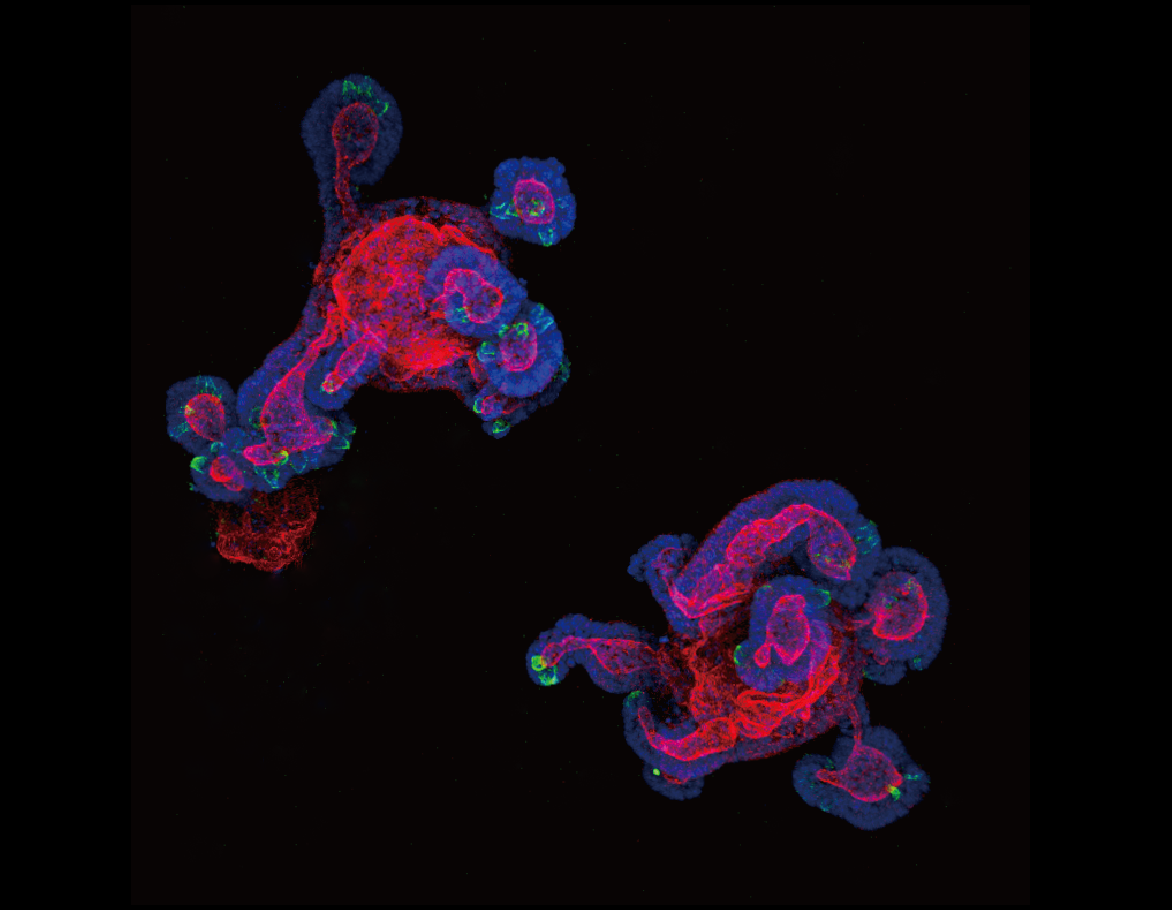Chromosome Rearrangements Drive Formation and Growth of Colorectal ...