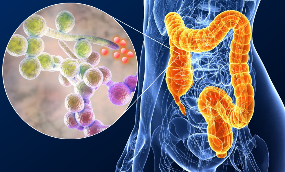 Toxin-producing Yeast Strains in Gut Fuel IBD | Newsroom | Weill ...