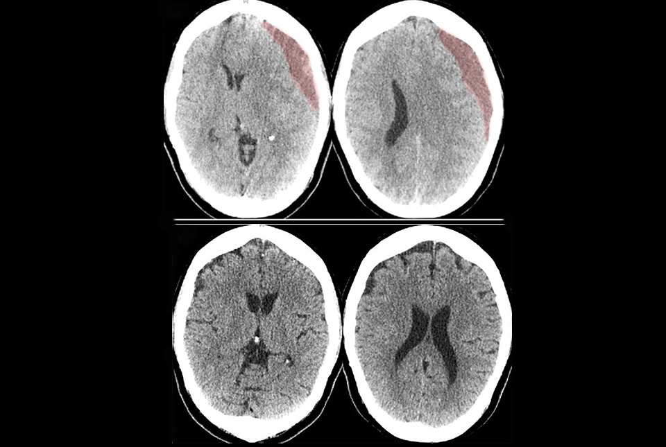 Subdural Hematoma Even The Elderly Can Recover From A Severe Traumatic