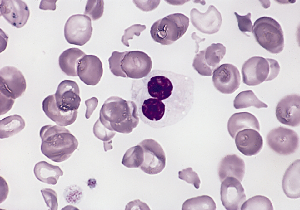 New Technique Illuminates How Abnormal RNA Splicing Leads to Disease ...