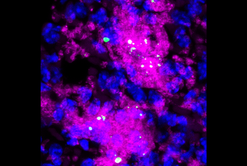 Cancer’s Ripple Effect May Promote Blood Clot Formation in the Lungs ...