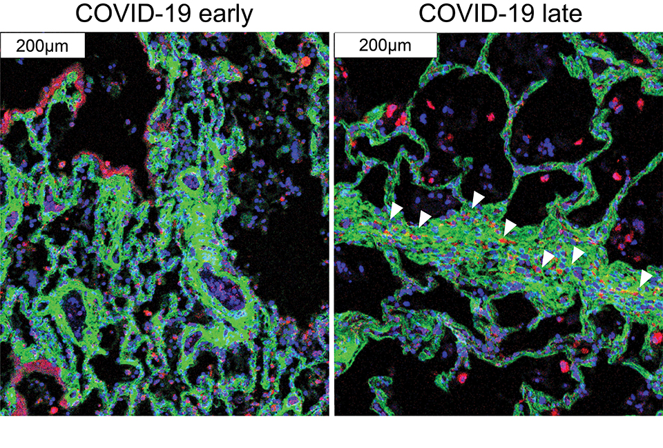 New Technique Provides Detailed Map of Lung Pathology in COVID-19 ...