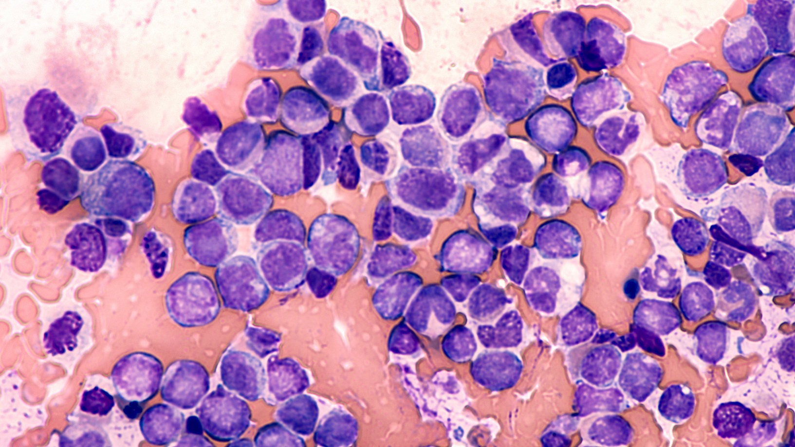 Study Finds Cancer Cells May Evade Chemotherapy by Going Dormant ...