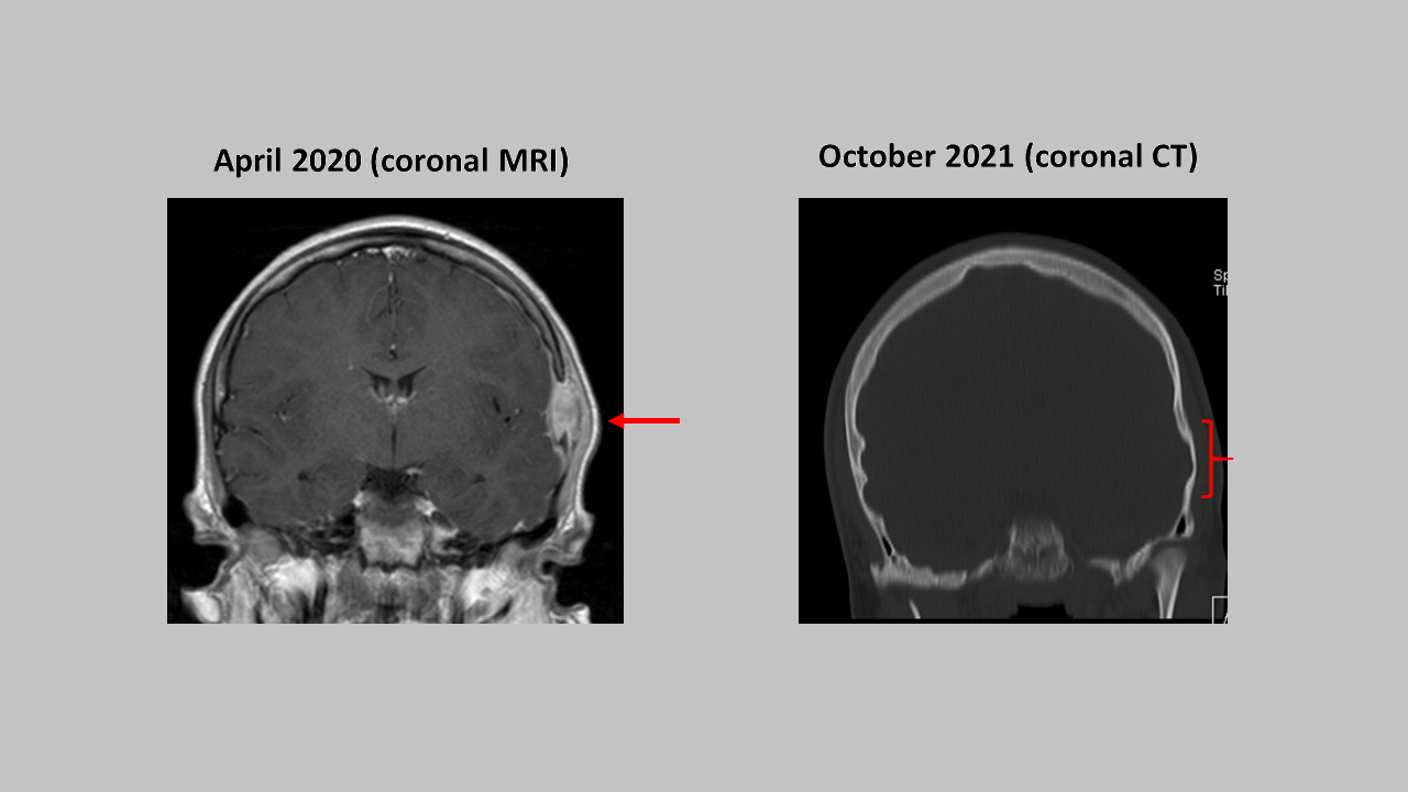 In Brief: Surgery May be Avoided for Children with Rare Skull Tumor ...
