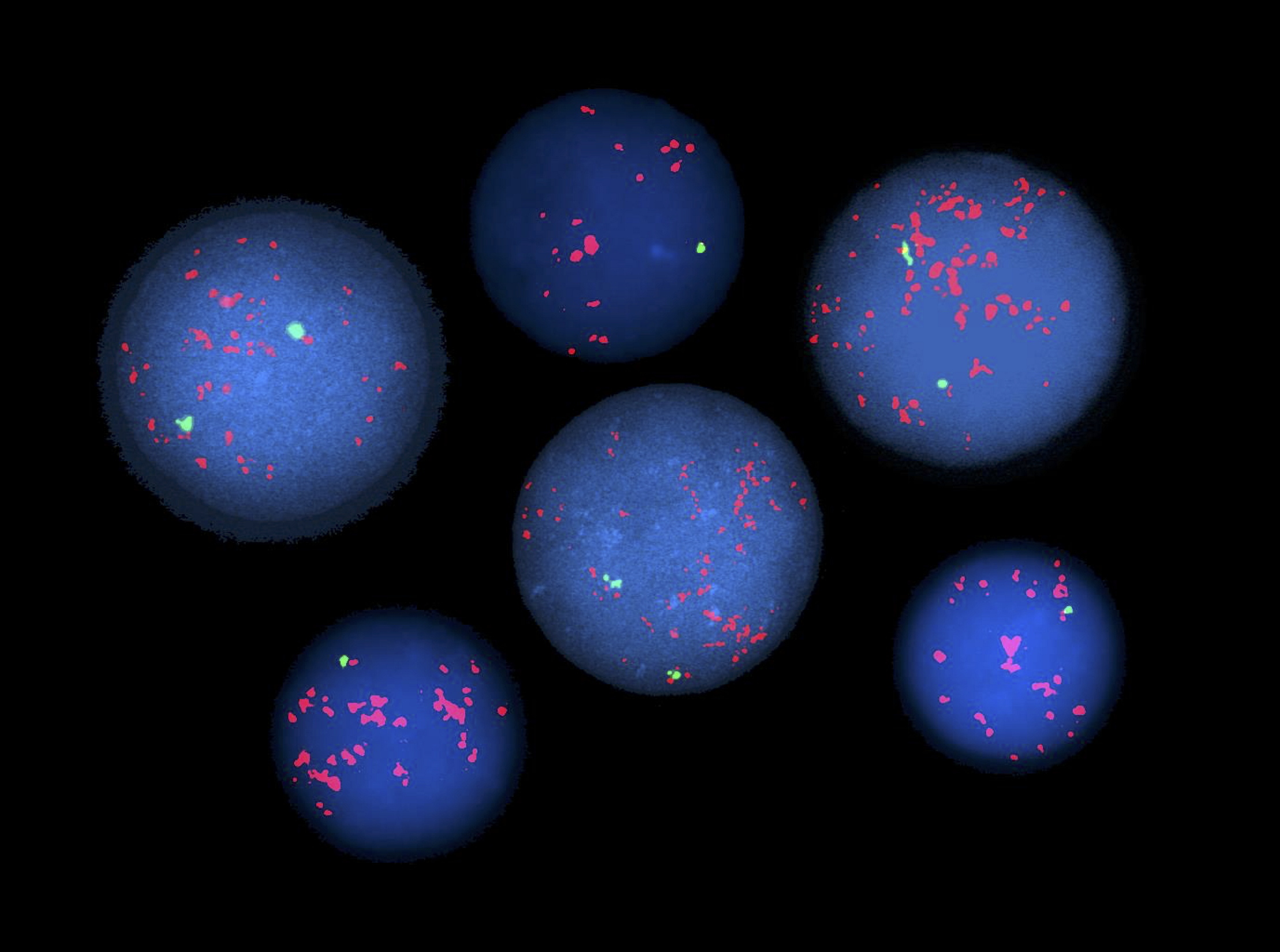 Gene Mutations Predicting Blood Cancer Risk Detectable a Decade Before ...